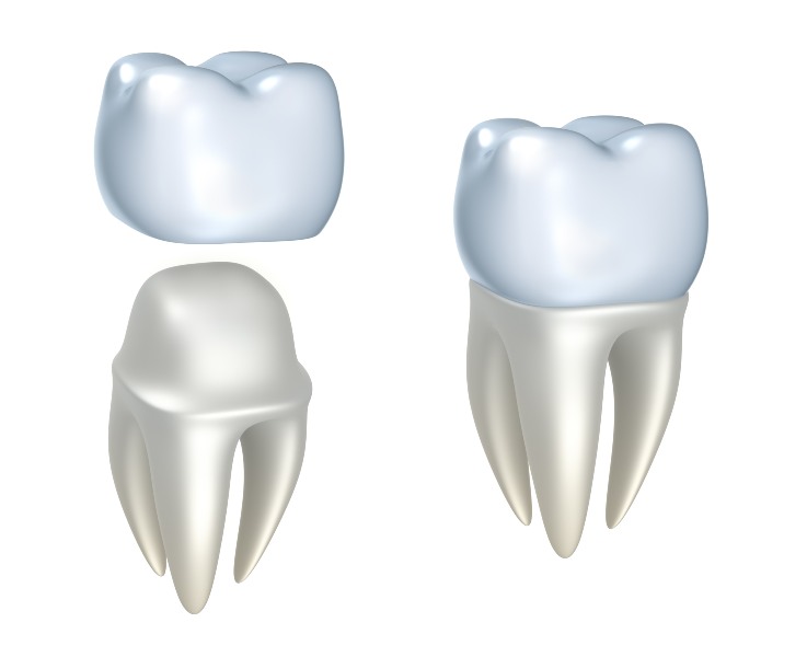 All-Ceramic Crowns - Trident Dental Lab